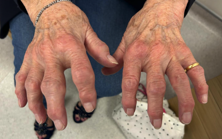 Investigational Use of Denosumab for Erosive Hand Osteoarthritis ...